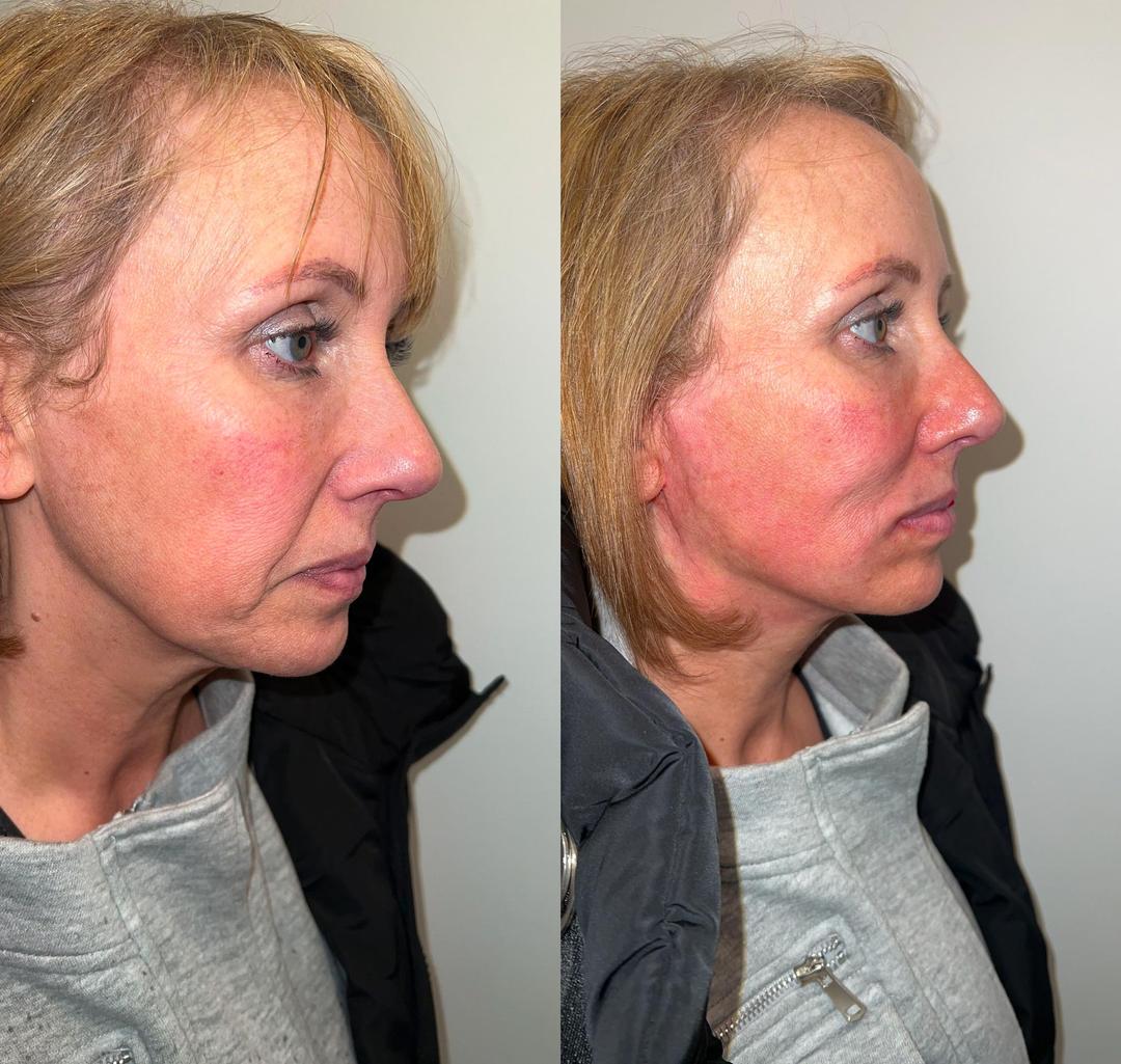 PDO Thread Lift Treatments | Recent Treatments | Wigtox