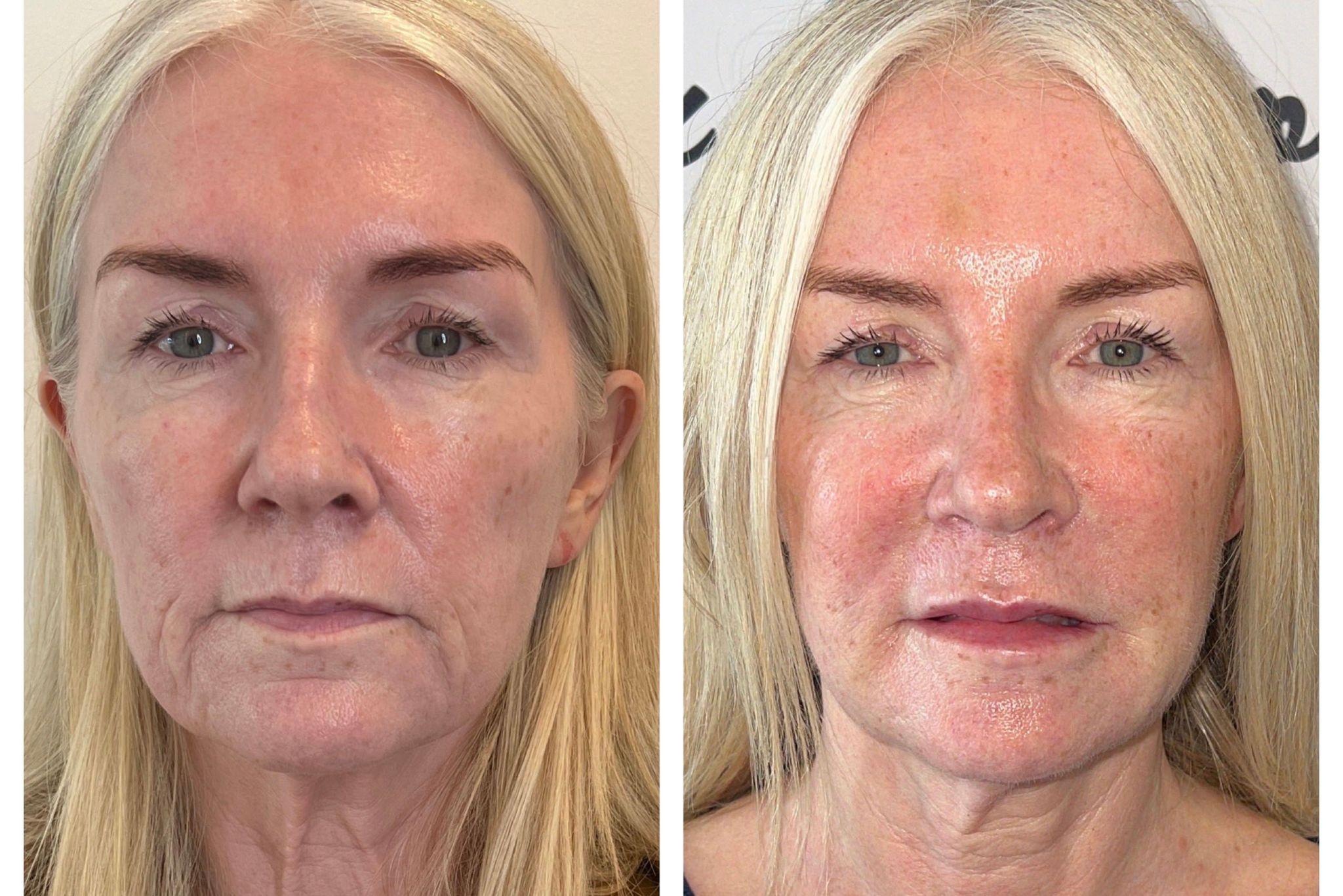 Botox & Dermal Filler Treatment Yorkshire | Recent Treatments | Wigtox