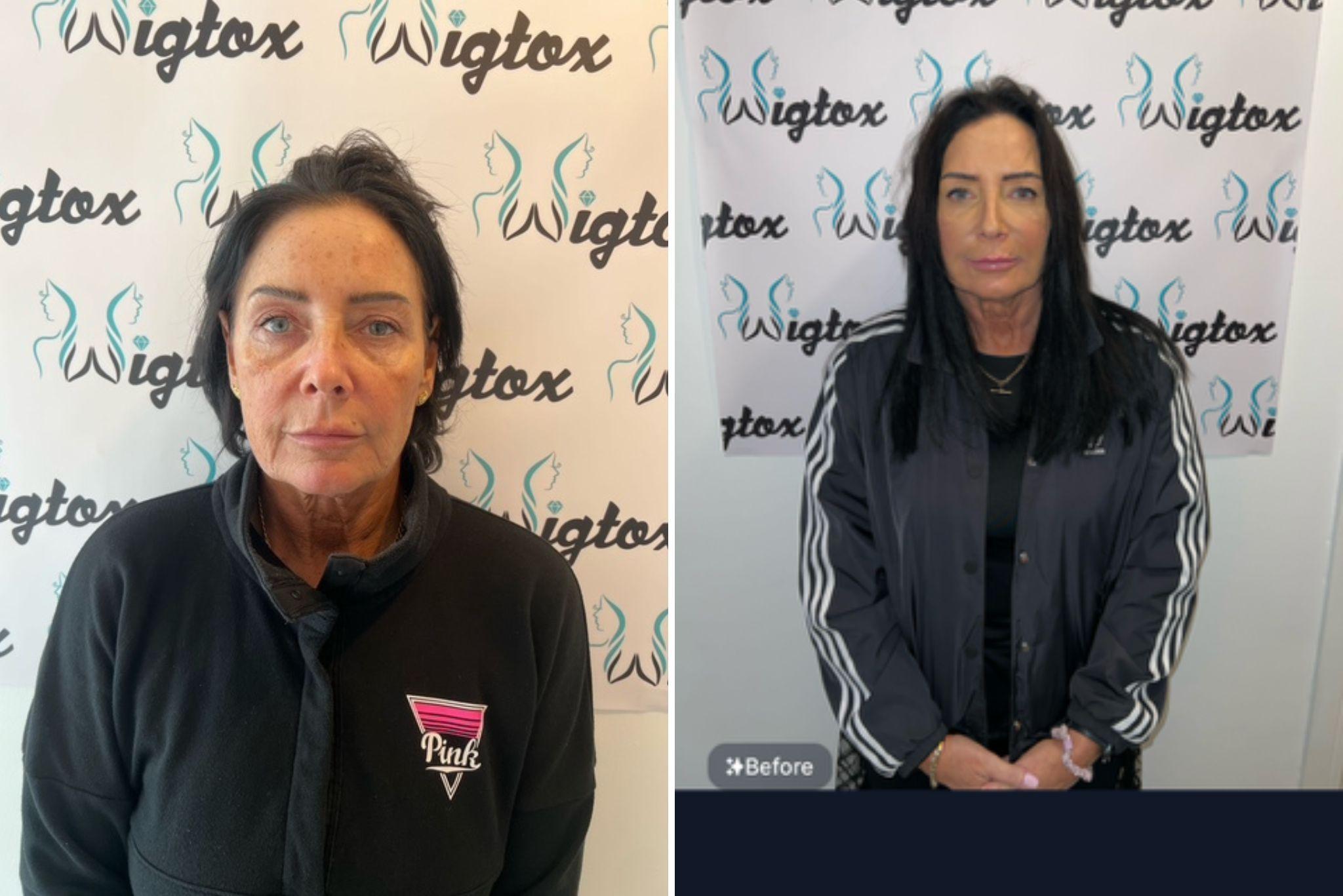 PDO Lift Yorkshire | Recent Treatments | Wigtox